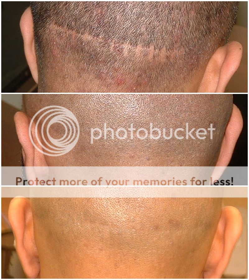 Strip (FUT) Scar Repair with SMP / Vinci Hair Clinic | Hair loss Forum ...